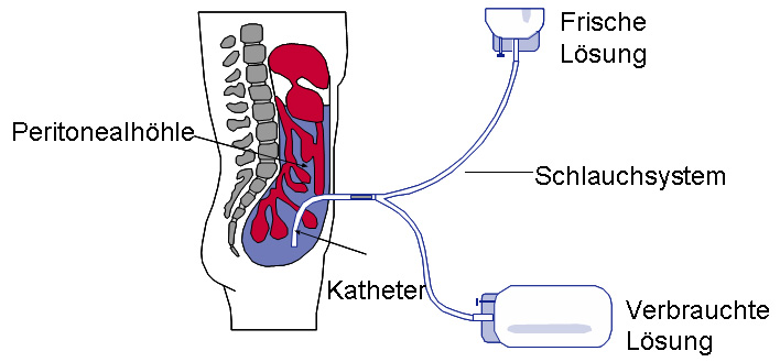 CAPD – ambulante Peritonealdialyse in Schwandorf